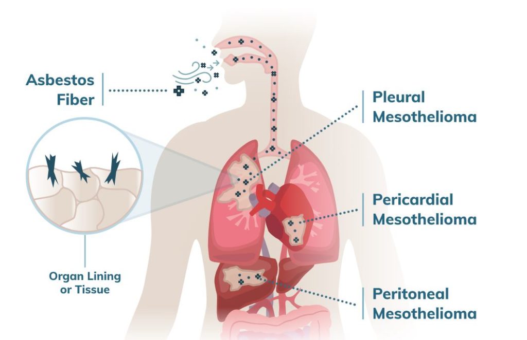 ¿Por qué veo tantos anuncios de mesotelioma?