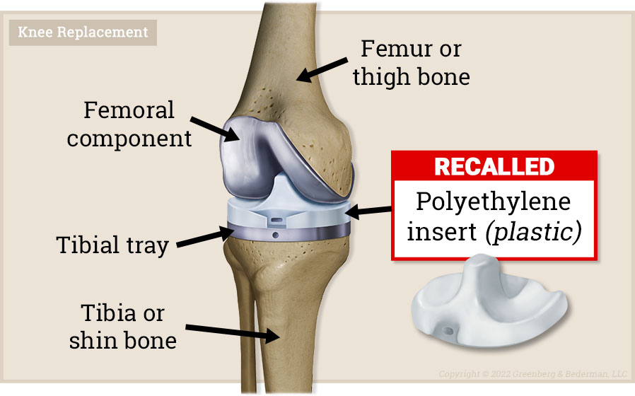 Recalled: Exactech knee and ankle implants | Allen and Allen