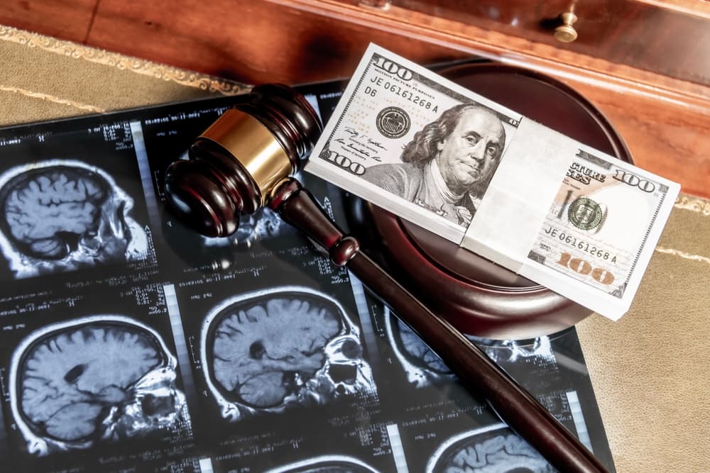 What's a good concussion car accident settlement amount? | Allen and Allen